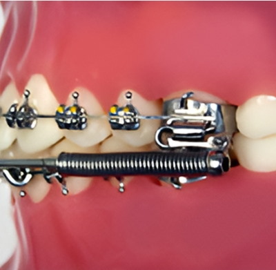 Advanced Orthodontic Appliances | Sprowls Orthodontics